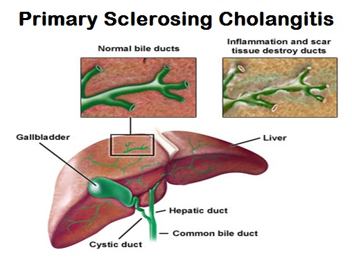 Primary Sclerosing Cholangitis
