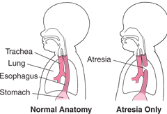 Oesophageal Atresia