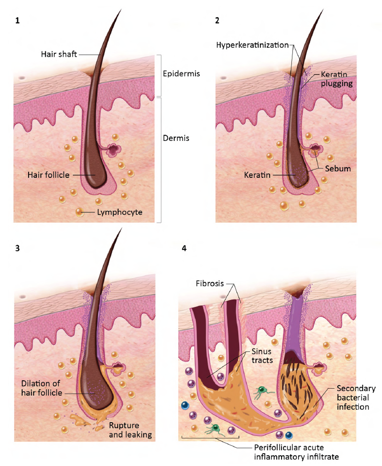 Hidradenitis Suppurativa